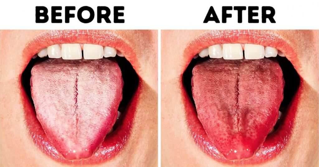 5 Ways to Get Rid of White Tongue and Make It Healthier – HealthW